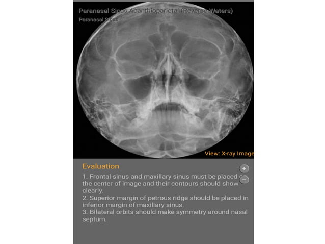 Positioning of Skull for X ray of PNS.pptx