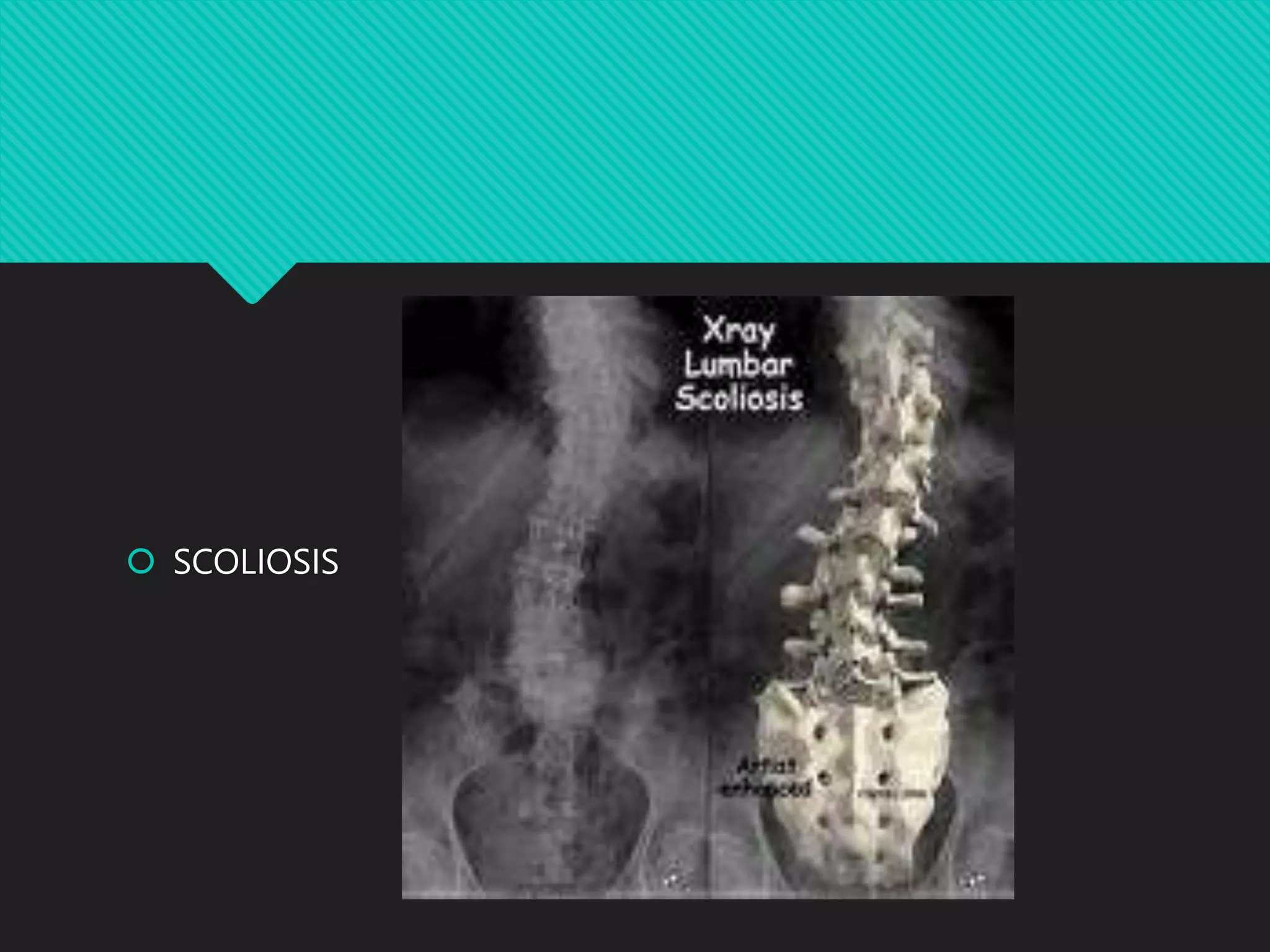 RADIOGRAPHY OF SPINE .pptx