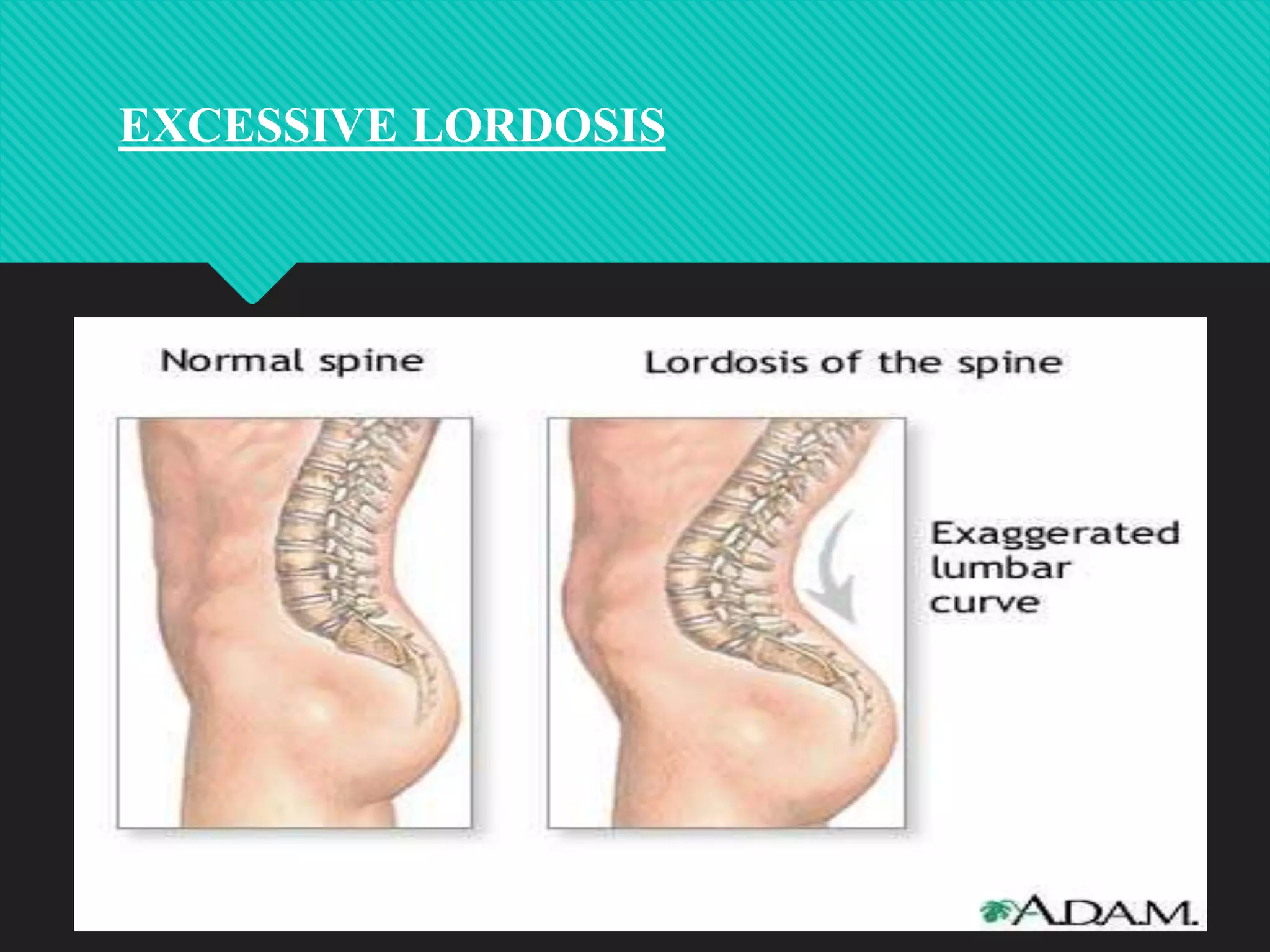RADIOGRAPHY OF SPINE .pptx