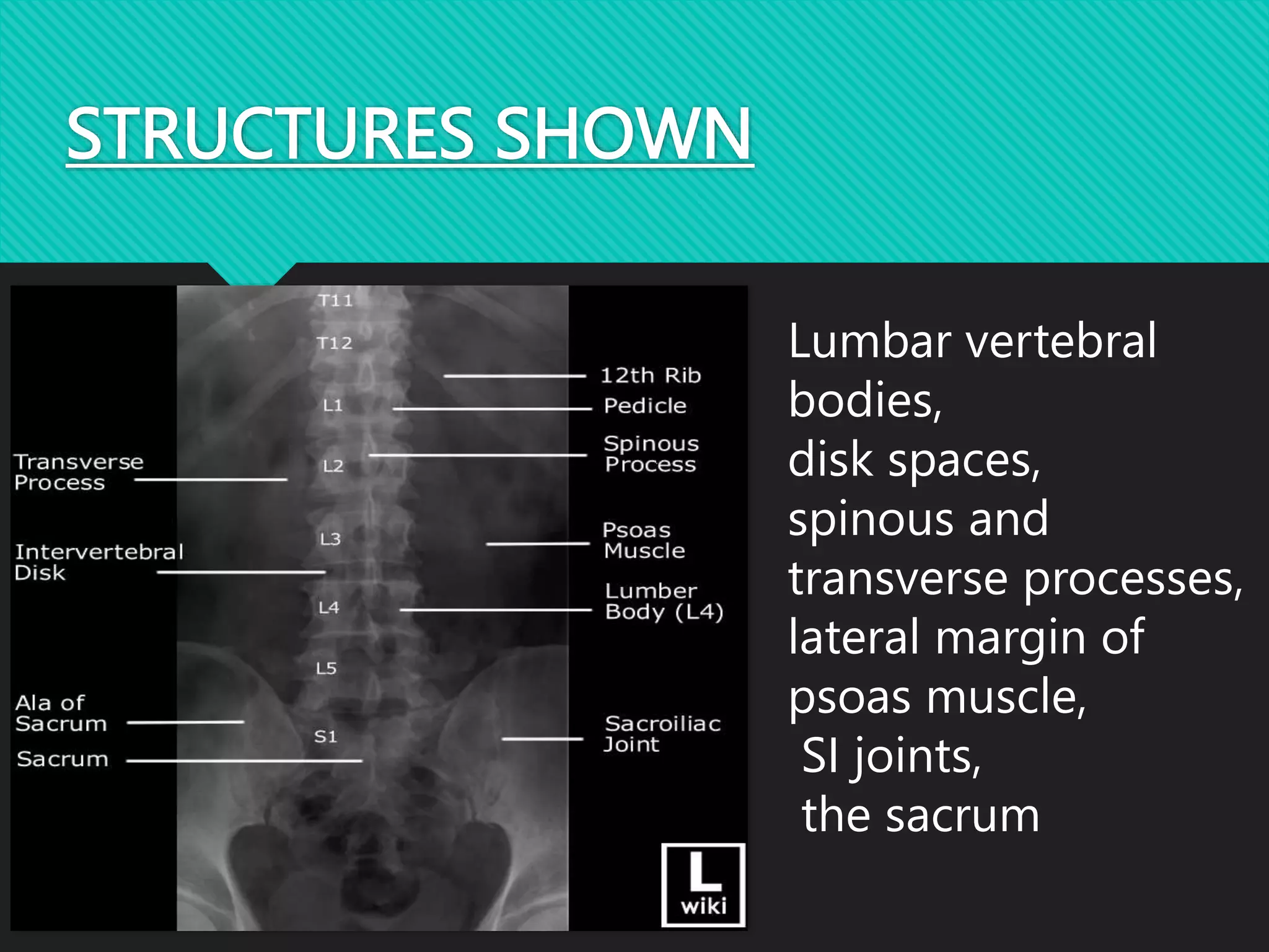 RADIOGRAPHY OF SPINE .pptx