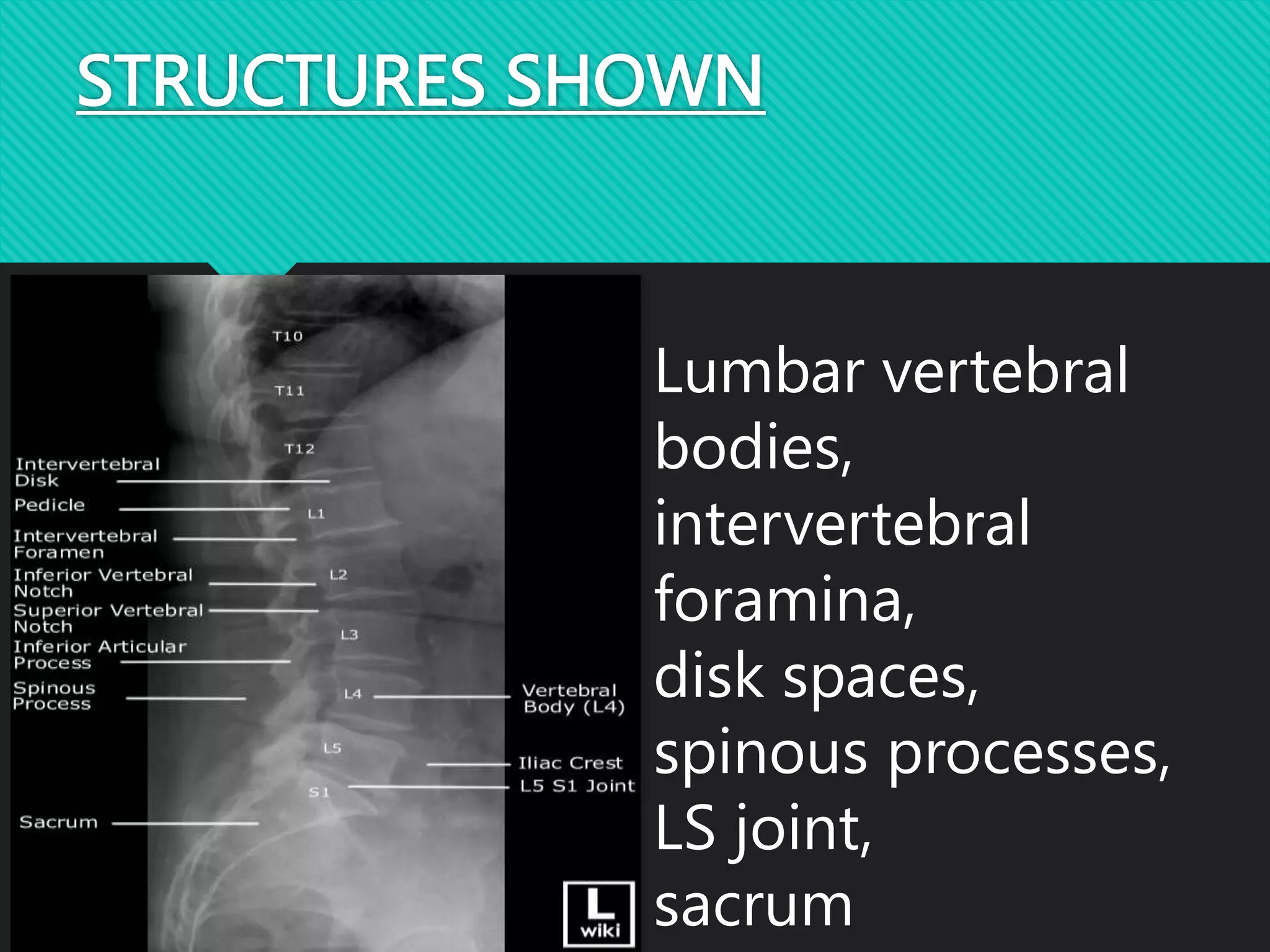 RADIOGRAPHY OF SPINE .pptx