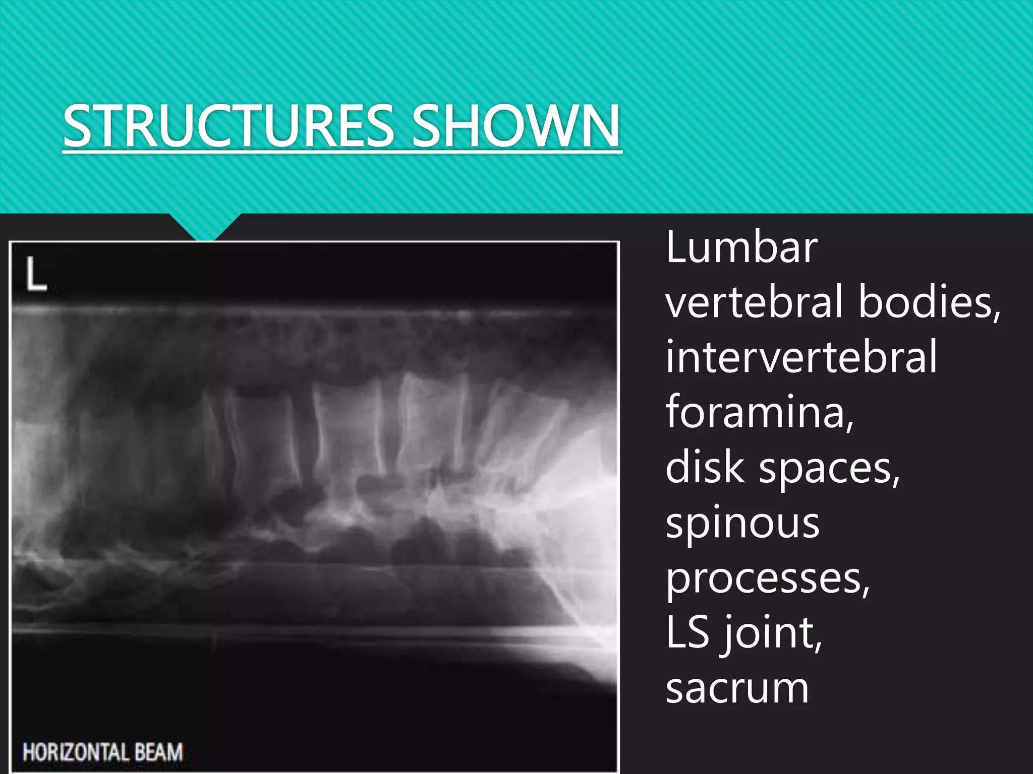 RADIOGRAPHY OF SPINE .pptx
