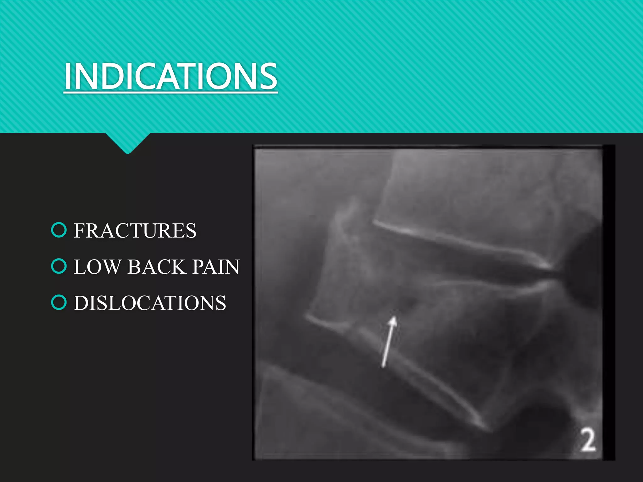 RADIOGRAPHY OF SPINE .pptx