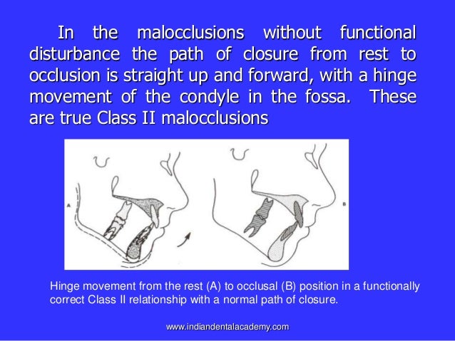 Position of condyle in cl ii & iii /certified fixed orthodontic cours…