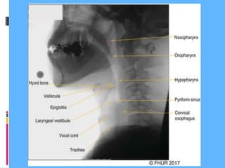 Pyriform Sinus Lateral View