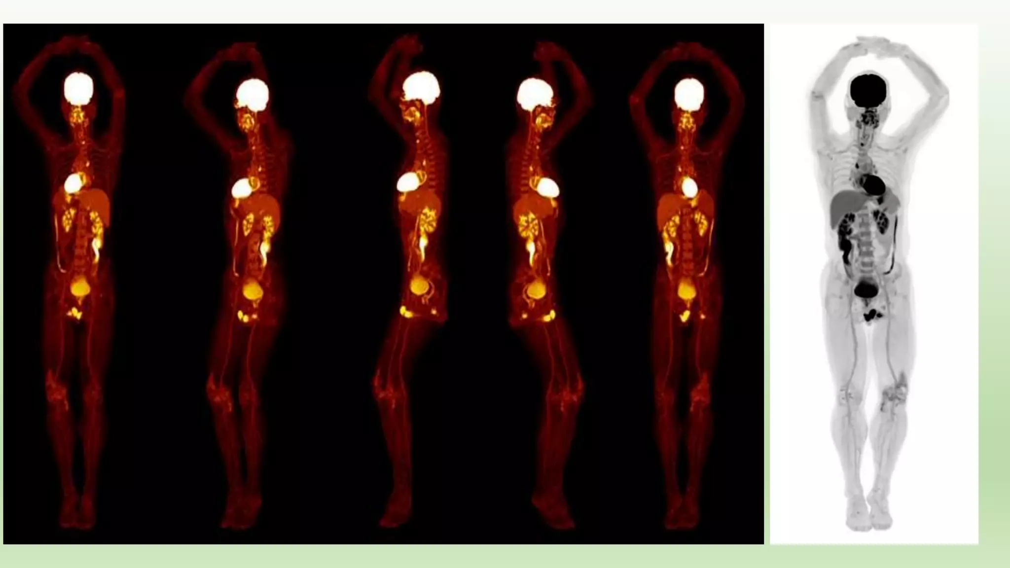 Positron emission tomography pet scan and its applications | PPTX