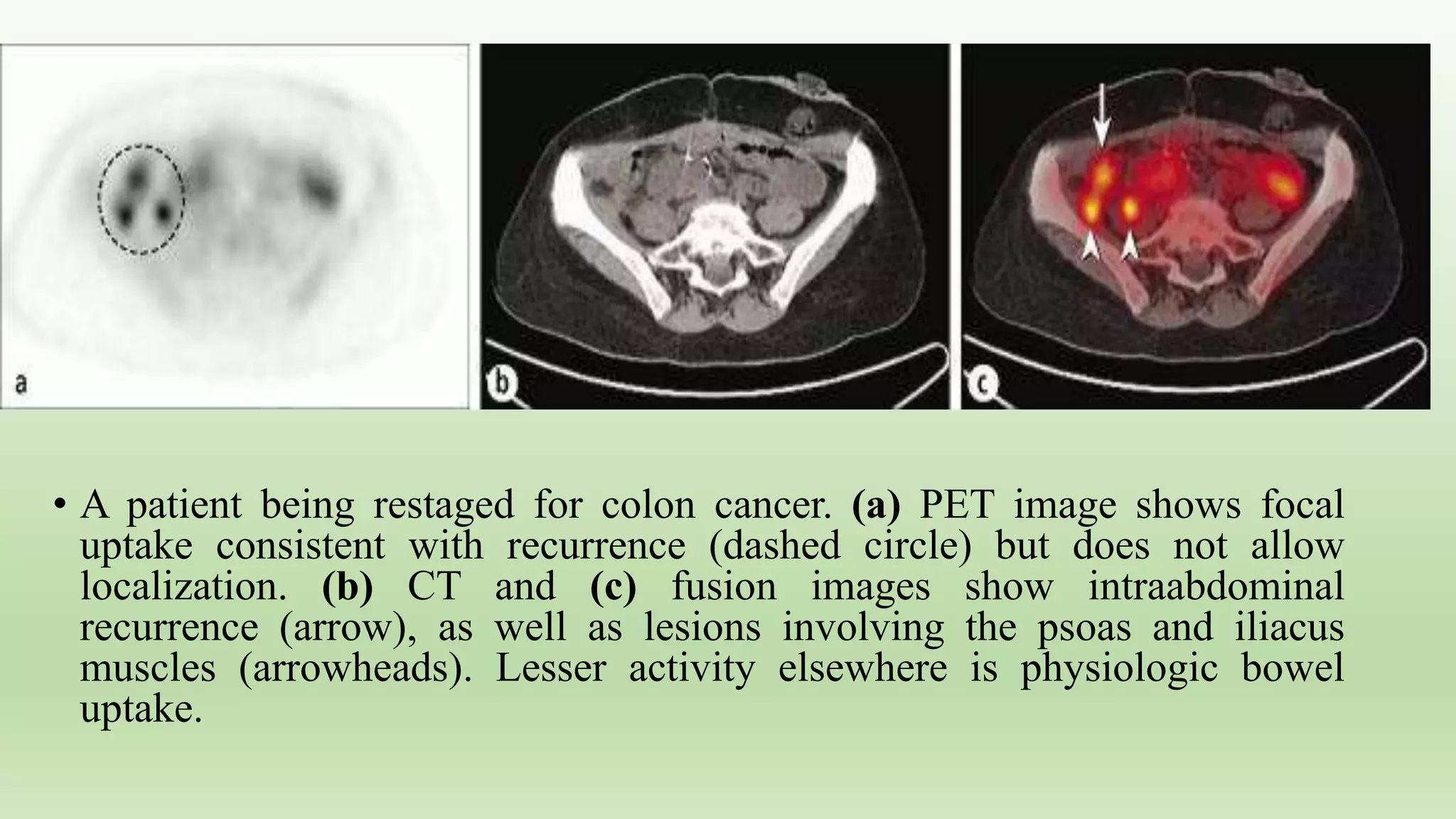 Positron emission tomography pet scan and its applications | PPTX