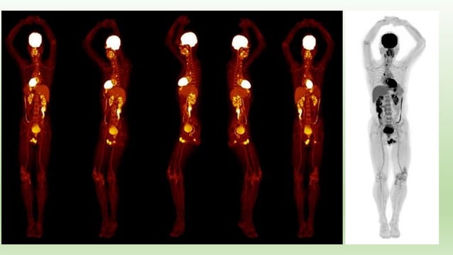 Positron emission tomography pet scan and its applications | PPTX