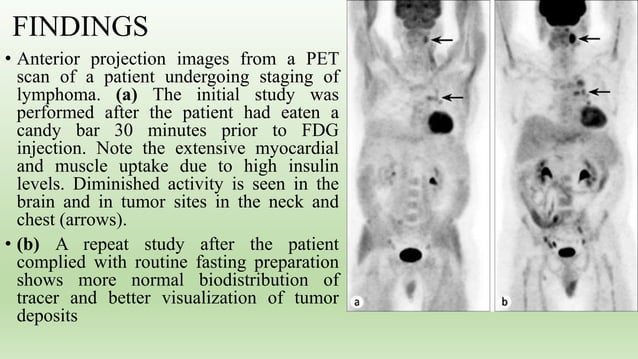 Positron emission tomography pet scan and its applications | PPTX