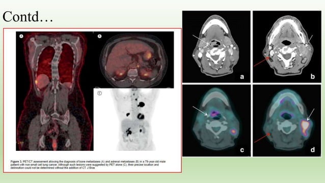 Positron emission tomography pet scan and its applications | PPTX