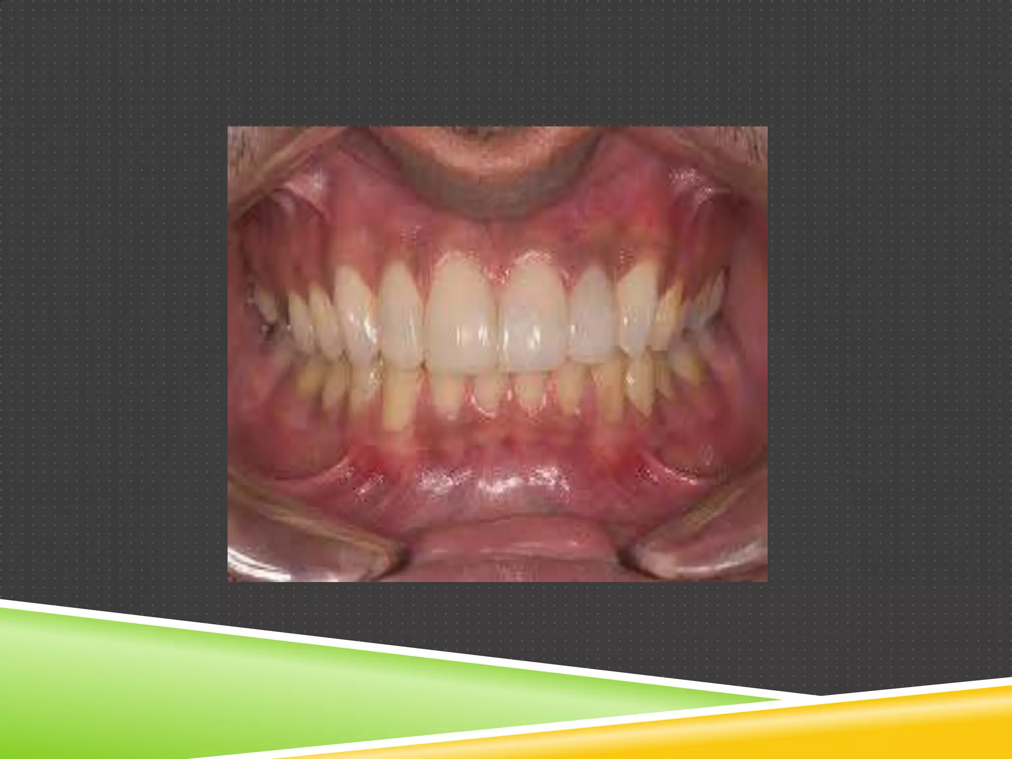 Posselt’s envelope | PPTX