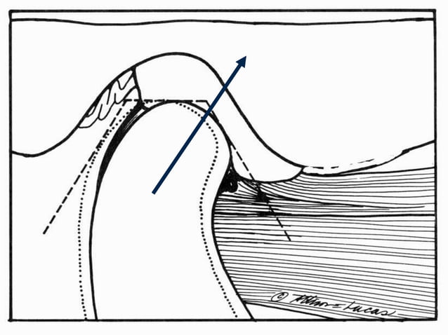 Posselt’s envelope | PPTX