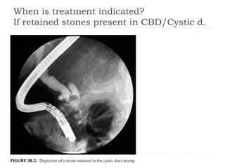 Post cholecystectomy complications | PPT