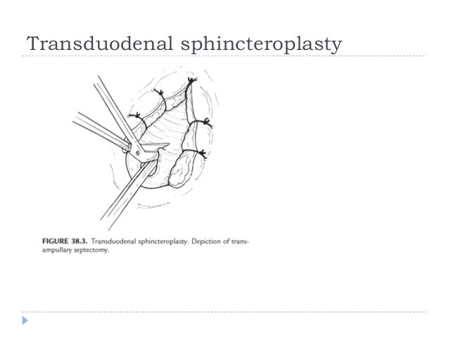Post cholecystectomy complications