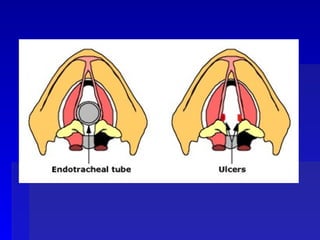 Post extubation stridor | PPT