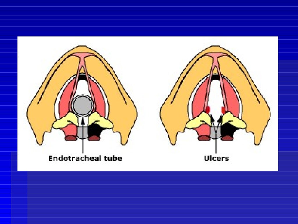 Post extubation stridor
