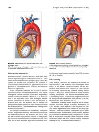 Post infarction left ventricular free-wall rupture | PDF | Heart and ...