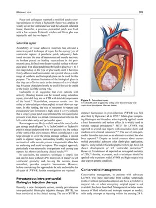 Post infarction left ventricular free-wall rupture | PDF | Heart and ...
