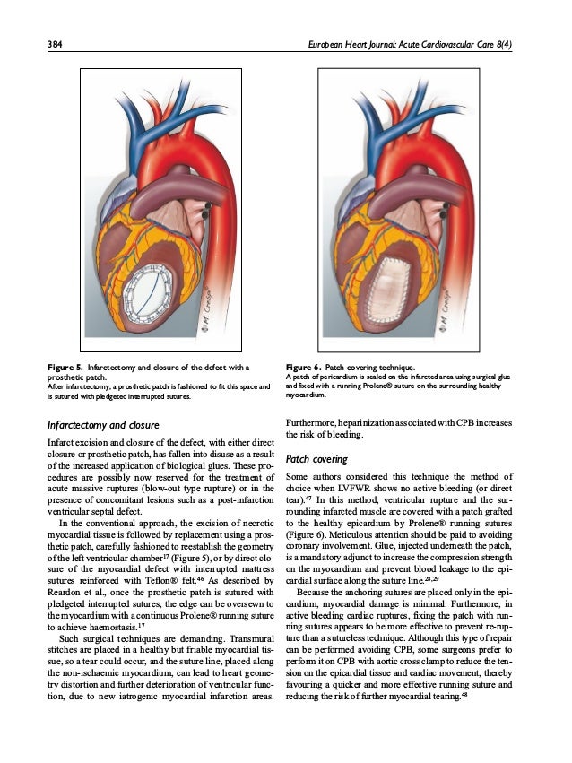 Post infarction left ventricular free-wall rupture