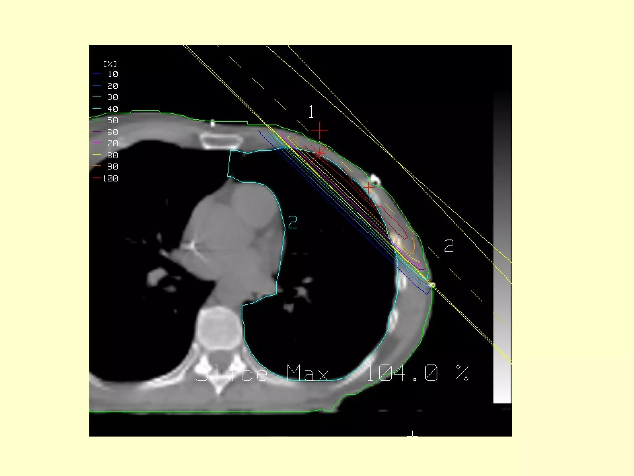 Post Mastectomy Radiotherapy | PPT