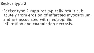 Post-MI Ventricular Septal Rupture.pptx