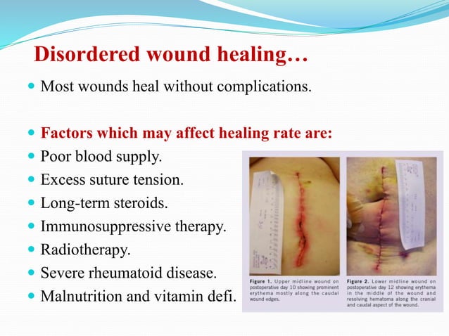 Post op....infection , oliguria, dvt.. | PPT