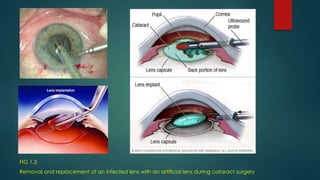 Post operative-corneal-edema | PPTX