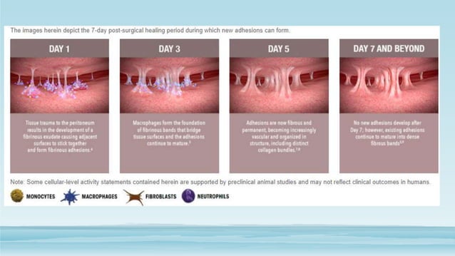 Post operative adhesions and management | PPTX | Death, Injury, or ...