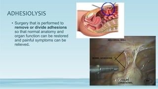 Post operative adhesions and management | PPTX