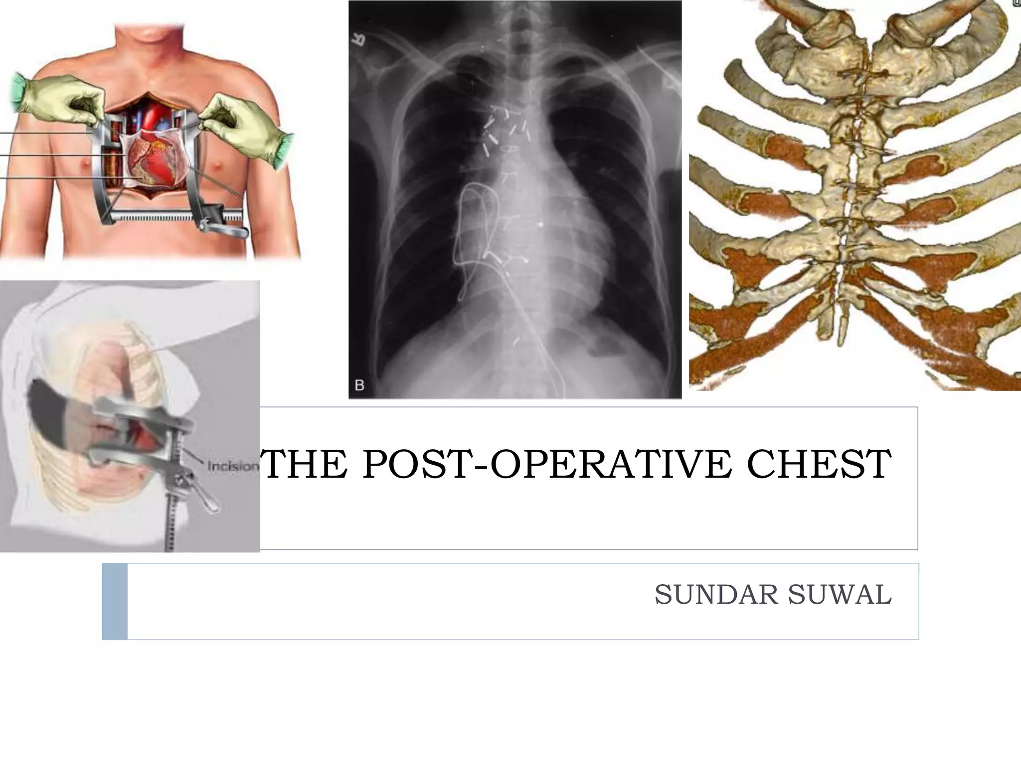 Post operative chest by Dr. Sundar Suwal | PPTX