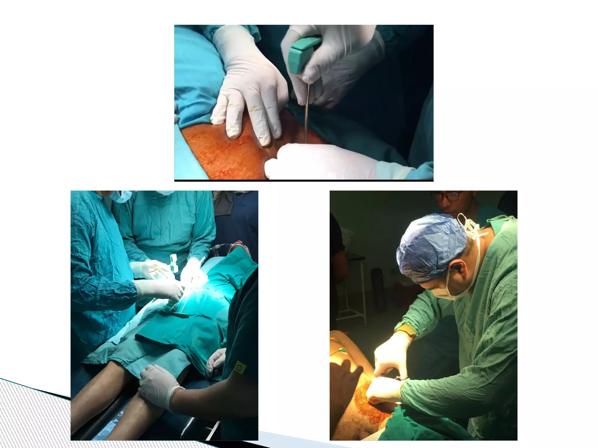 Post parathyroidectomy hypocalcemia dng 2019prof.osama elshahata | PPT