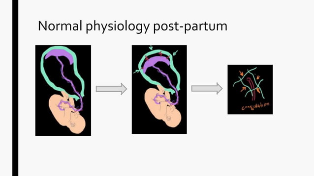 Post partum hemorrhage LB | PPT