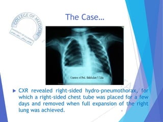Post-pneumonic Hydro-Pneumothorax.pdf