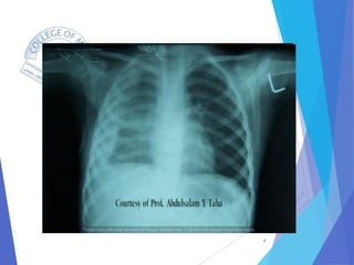 Post-pneumonic Hydro-Pneumothorax.pdf