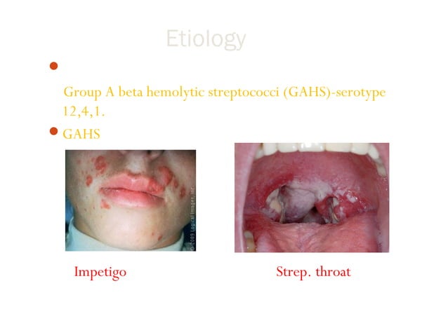 Post-Streptococcus Glomerulonephritis | PPT