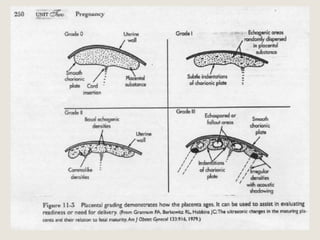 Post term pregnancy | PPTX