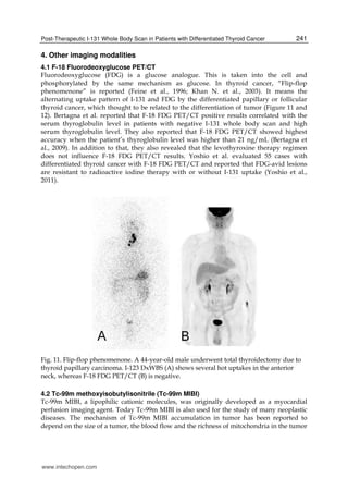 Post therapeutic i-131 whole body scan in | PDF