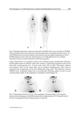 Post therapeutic i-131 whole body scan in | PDF