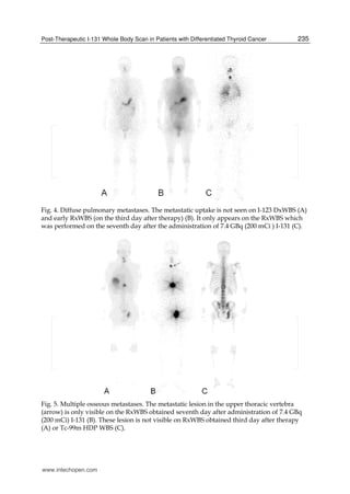 Post therapeutic i-131 whole body scan in | PDF