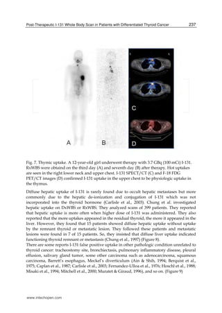 Post therapeutic i-131 whole body scan in | PDF