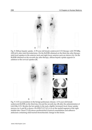 Post therapeutic i-131 whole body scan in | PDF