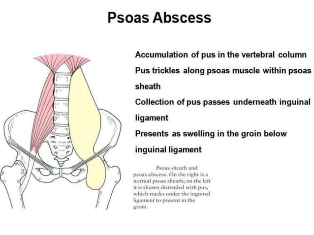 POST ABD WALL PPT.ppt