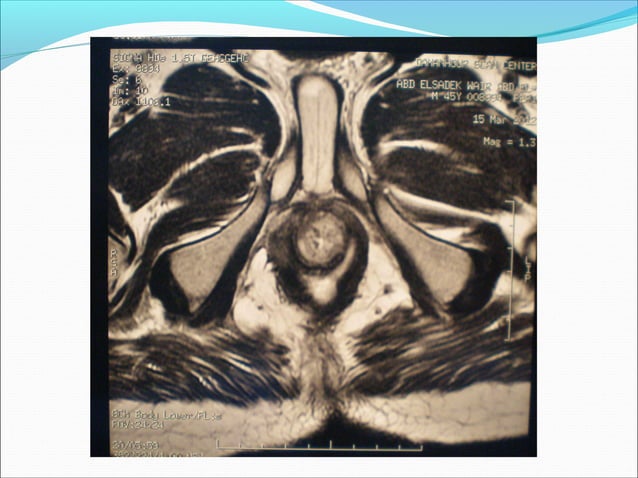 Postanal space fistula | PPT | Surgery | Medical Health
