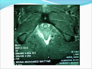 Postanal space fistula | PPT