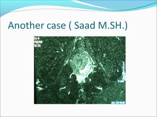 Postanal space fistula | PPT
