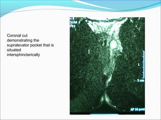 Postanal space fistula | PPT