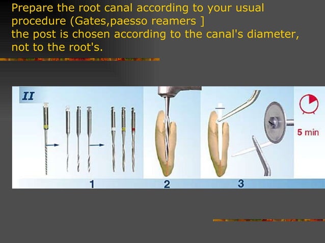 Post and core | PPT | Oral care | Personal Care