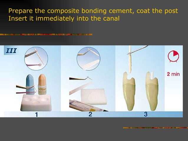 Post and core | PPT | Oral care | Personal Care