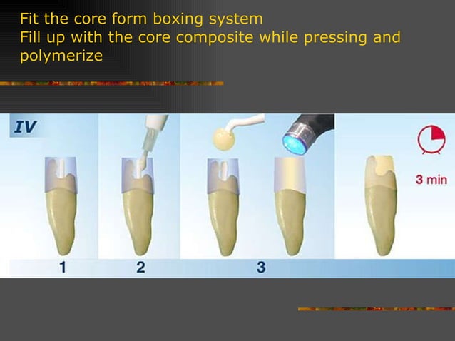Post and core | PPT | Oral care | Personal Care