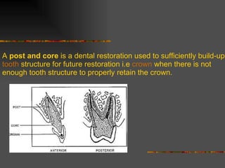 Post and core | PPT